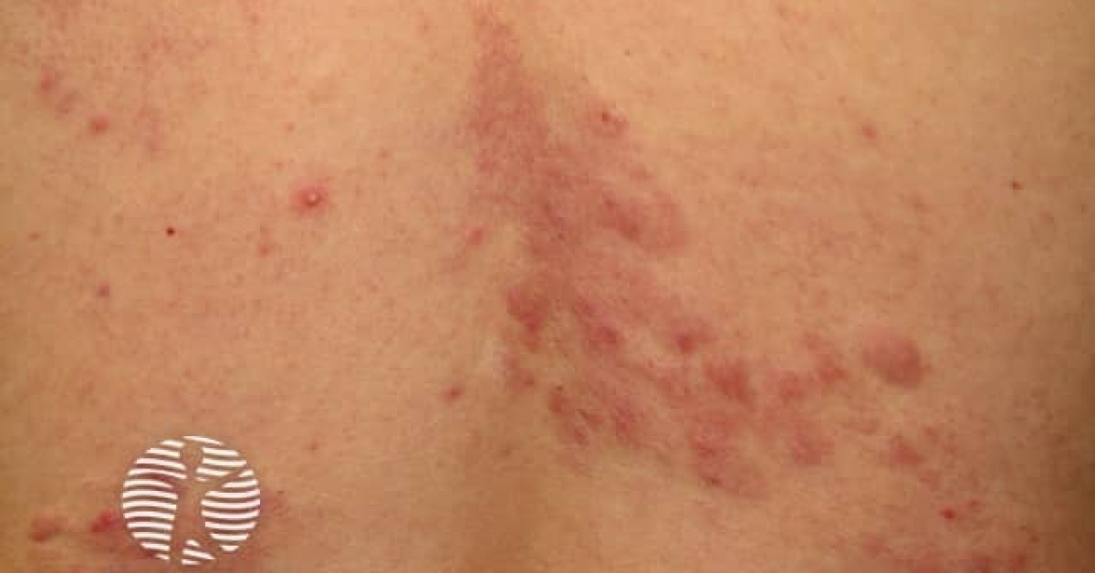 Shagreen patch in tuberous sclerosis image