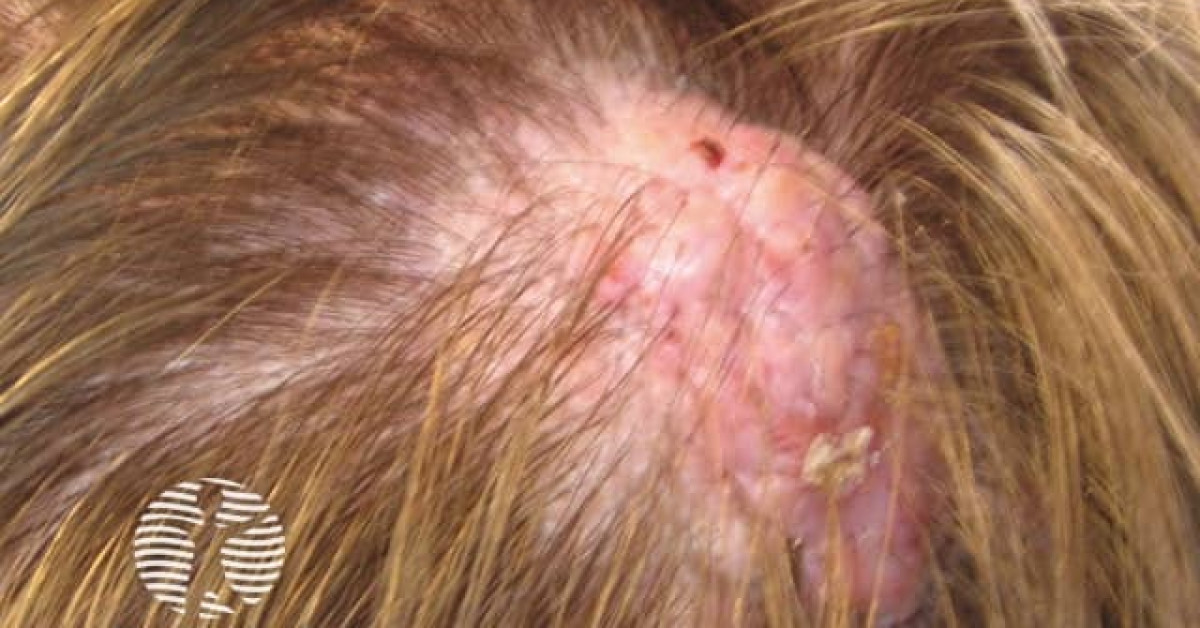 Shagreen patch in tuberous sclerosis image