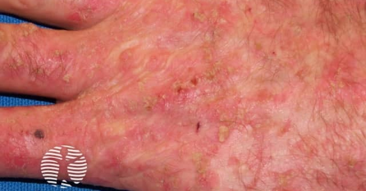 Actinic keratoses image
