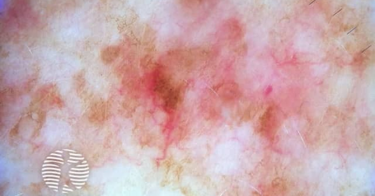 Telangiectatic cutaneous mastocytosis dermatoscopy image