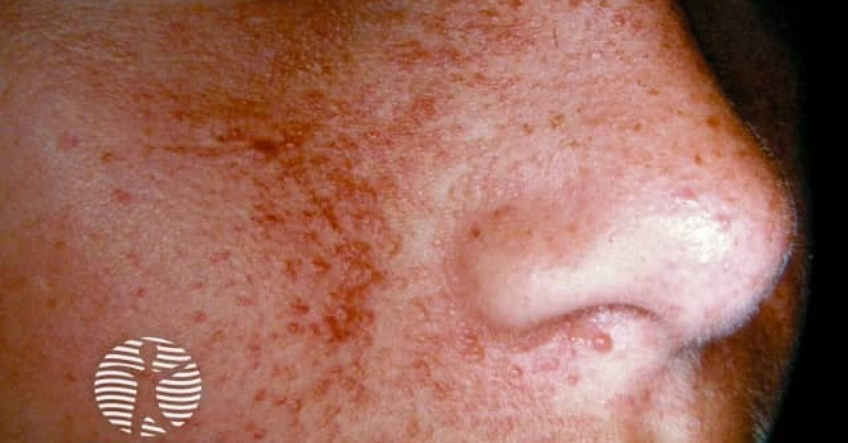 Angiofibromas in tuberous sclerosis image