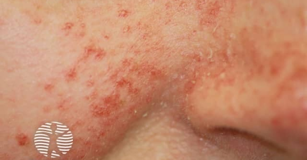 Angiofibromas in tuberous sclerosis image