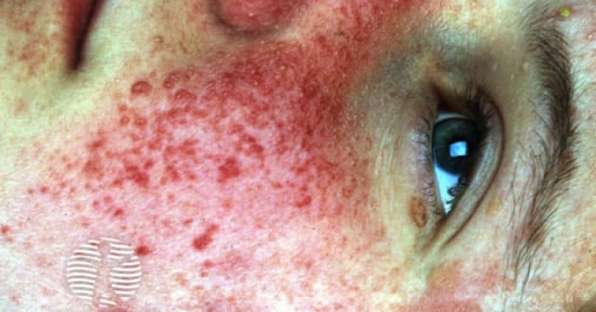 Angiofibromas in tuberous sclerosis image