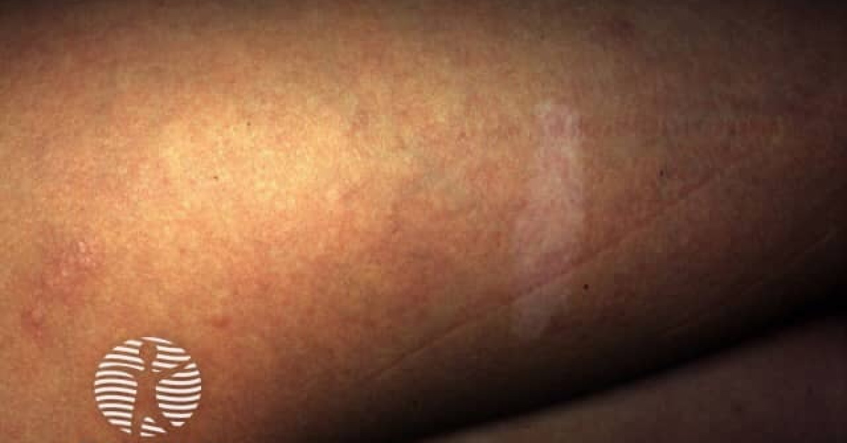 Ash leaf marks in tuberous sclerosis image