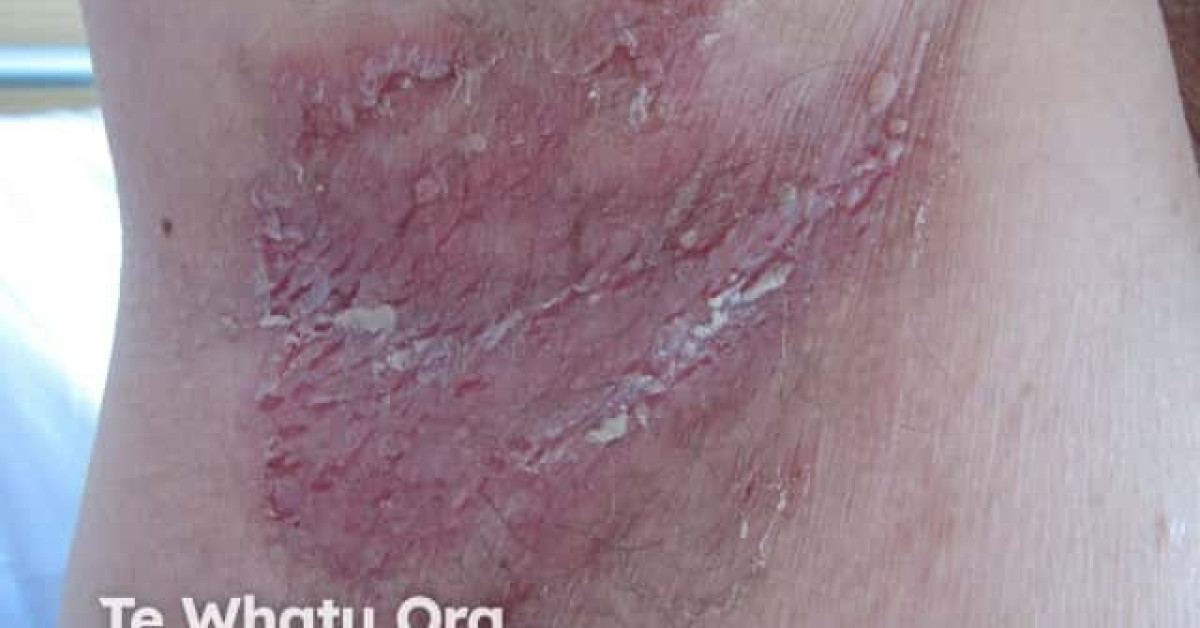 Intertrigo due to Hailey-Hailey disease image