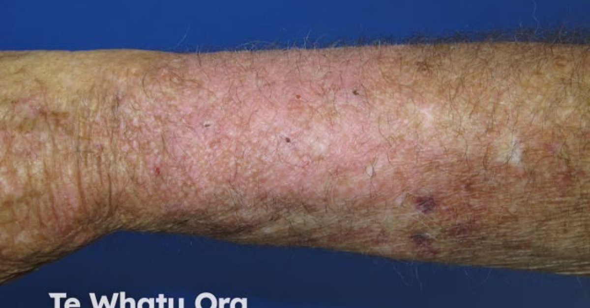 Lichen simplex image