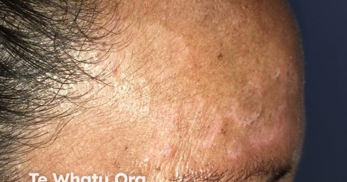 Seborrhoeic dermatitis image