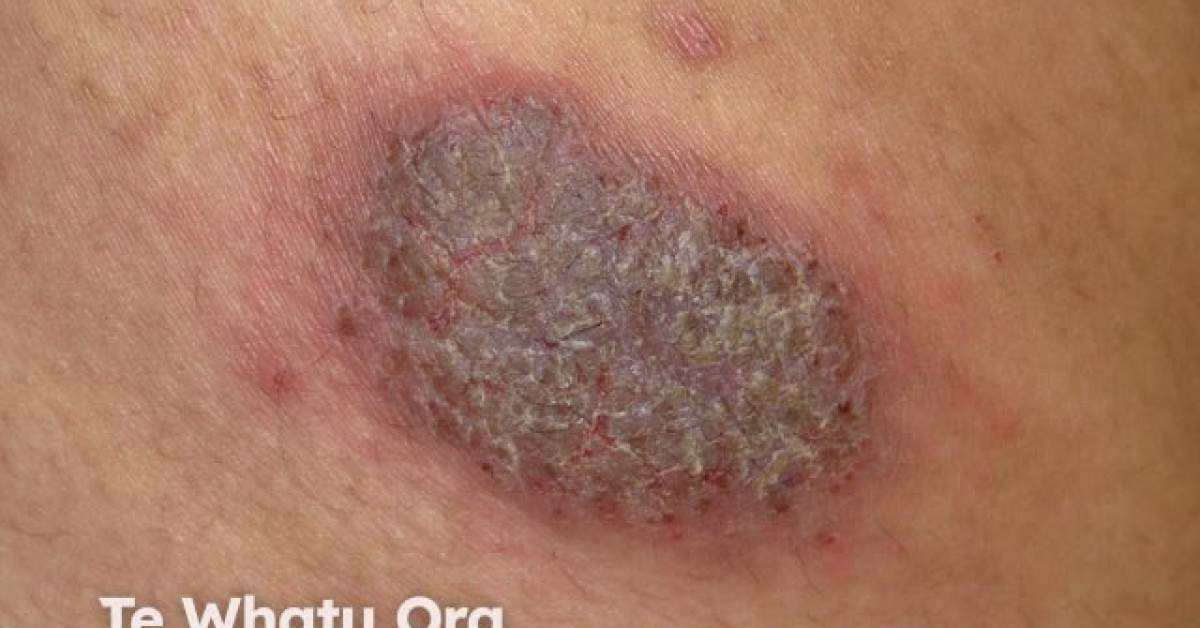 Discoid eczema image