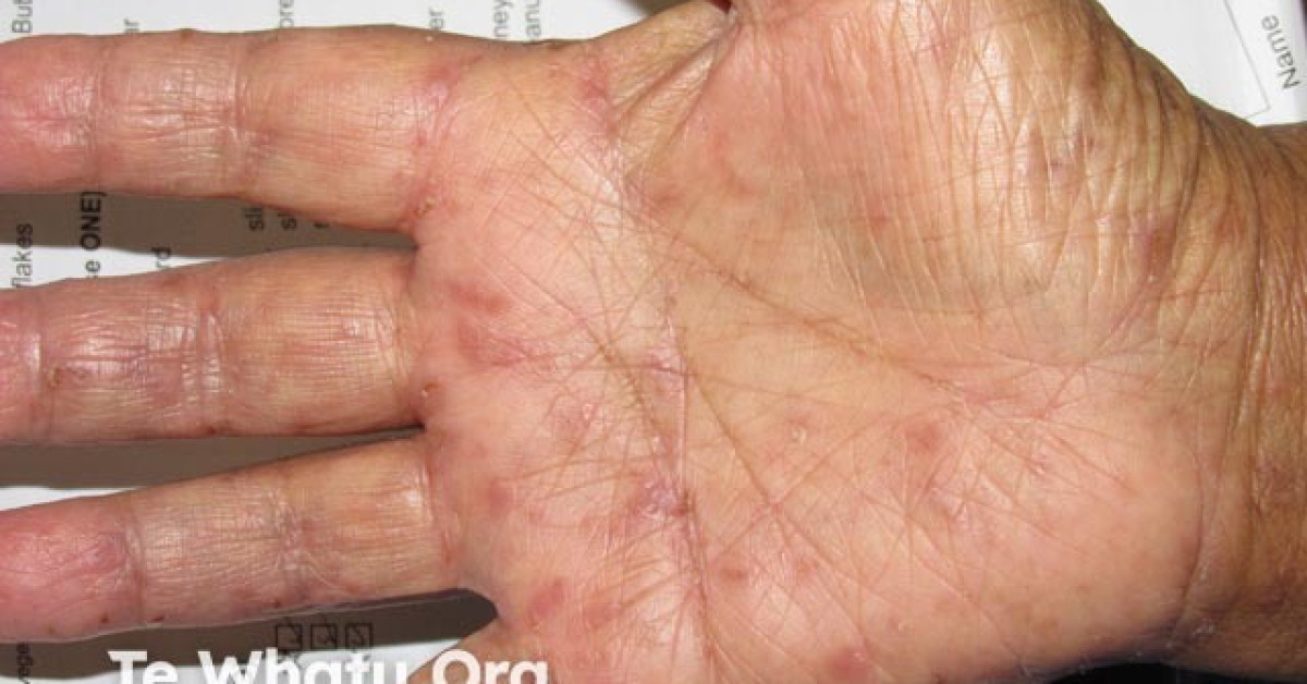 Scabies image