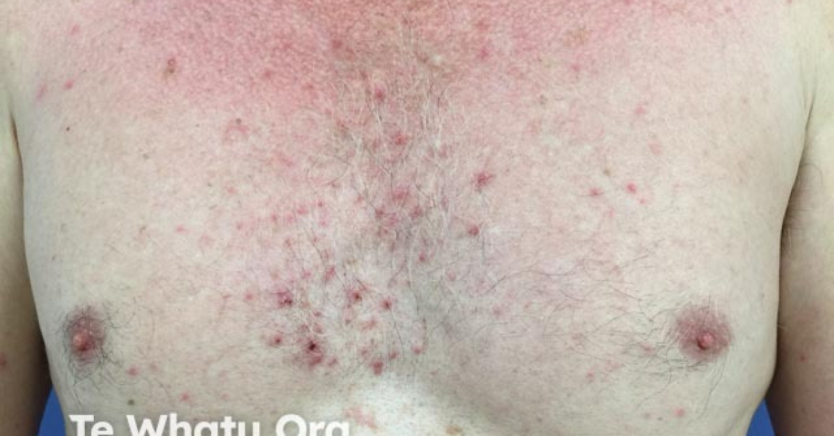 Transient acantholytic dermatosis image