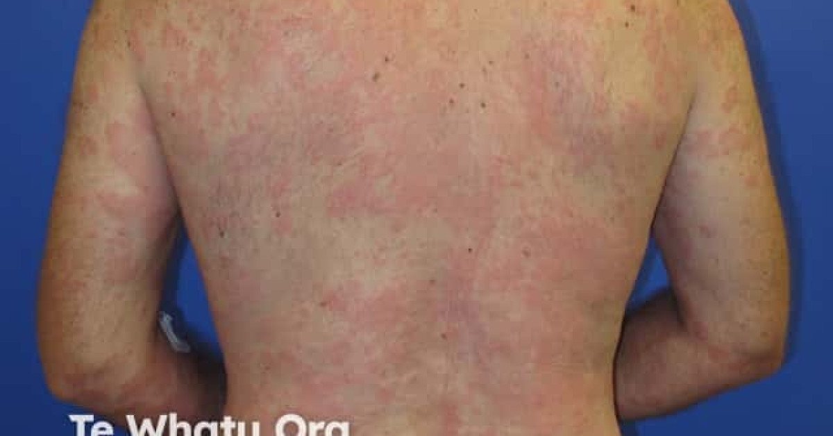 Urticaria image