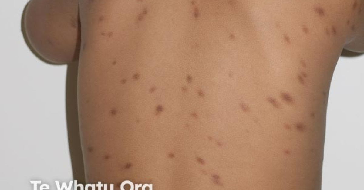 Urticaria Pigmentosa Mastocitose Maculopapuleuze Cutane Mastocytose