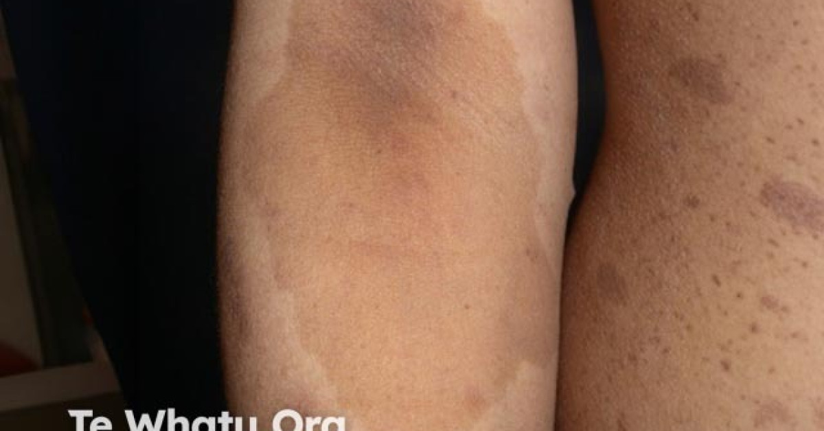 Neurofibromatosis image