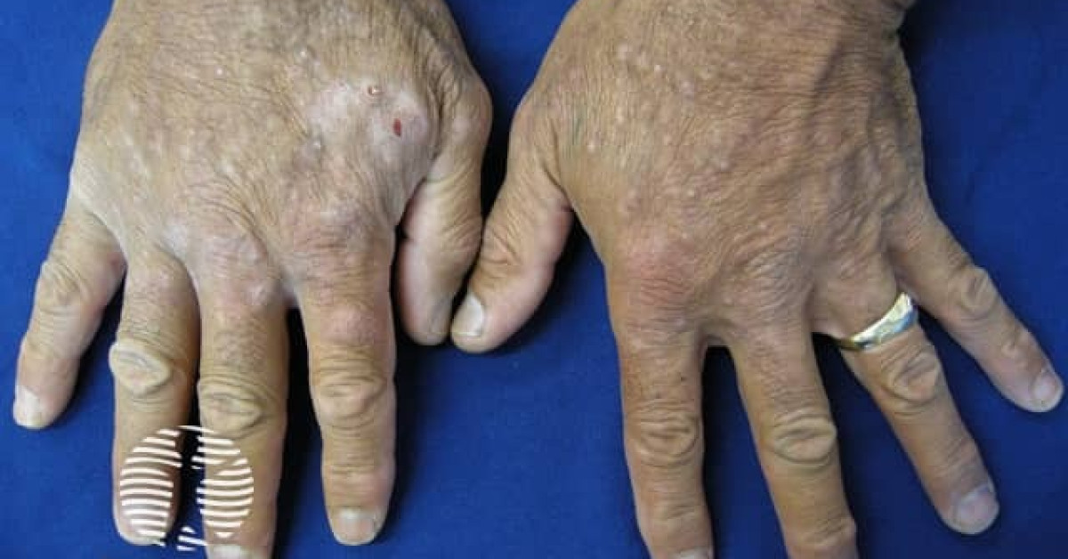 Skin lesions in Whipple disease image