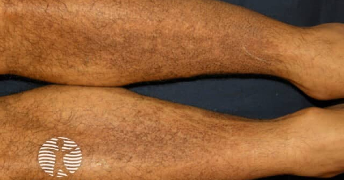 Skin lesions in Whipple disease image