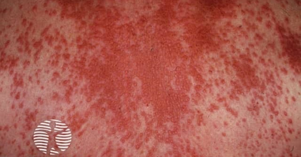 Xanthoma disseminatum image