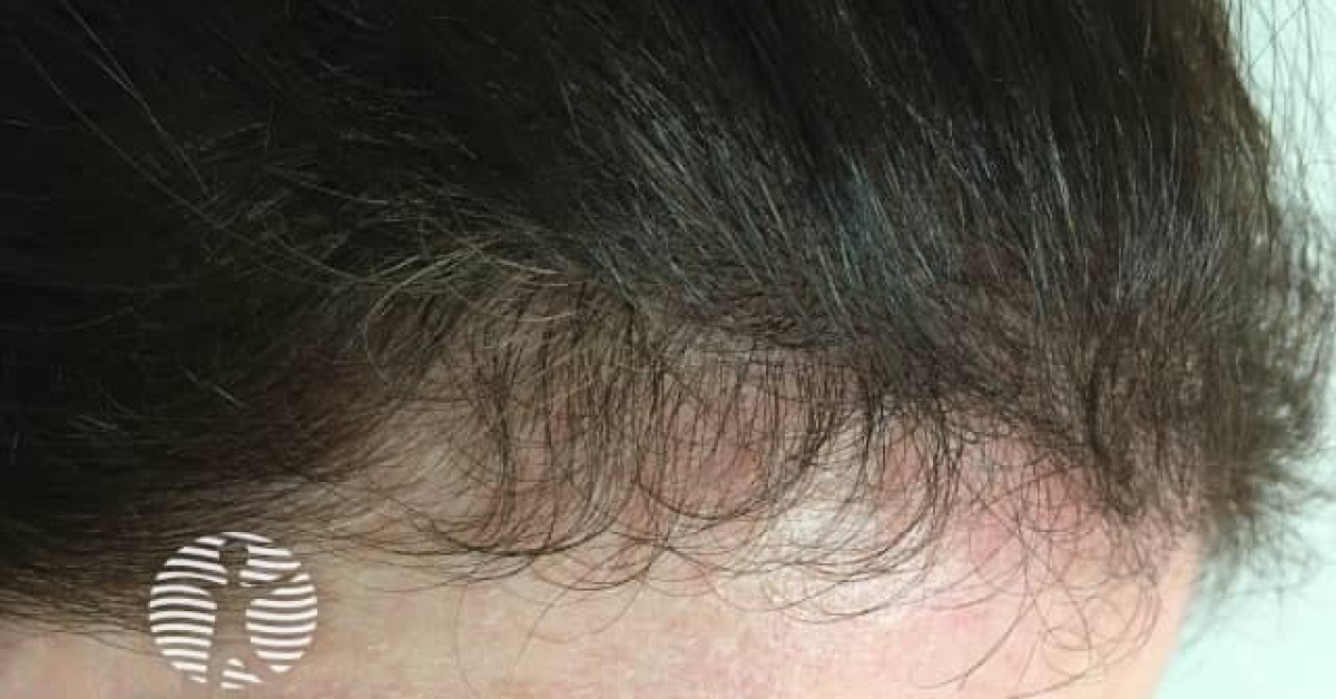 Telogen effluvium image