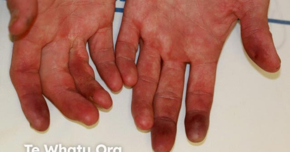 Thromboangiitis obliterans image