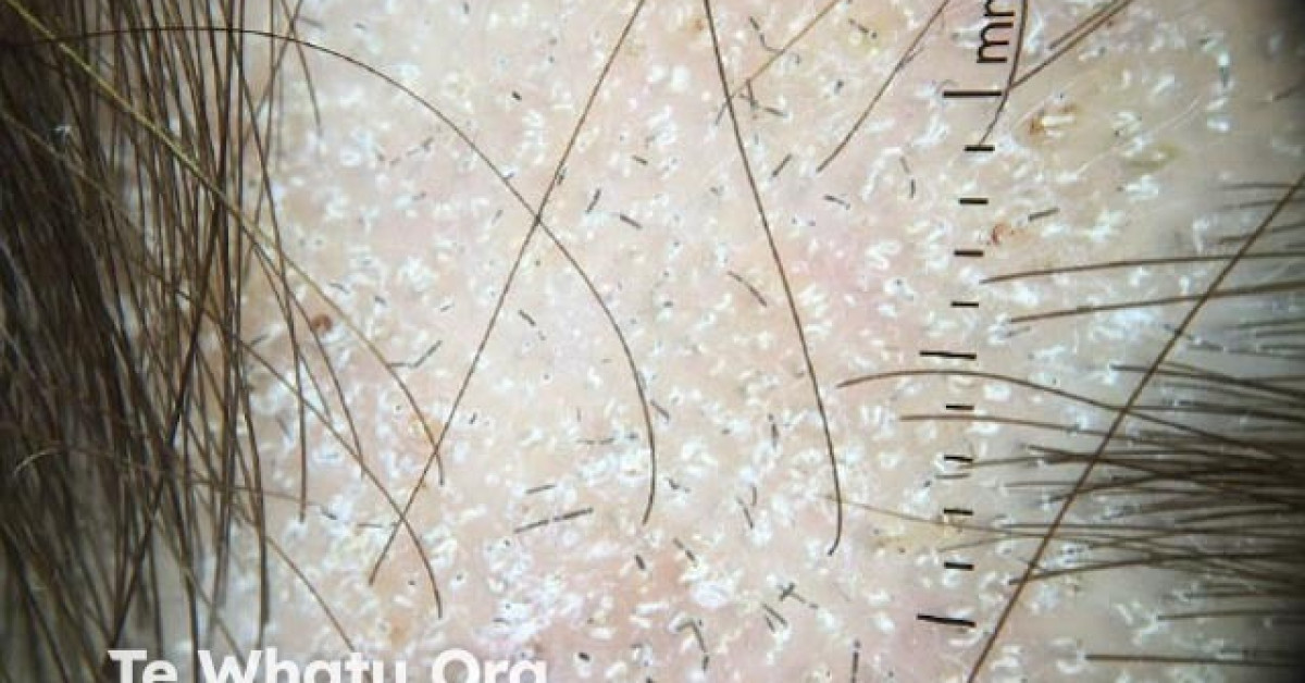 Tinea capitis dermoscopy image