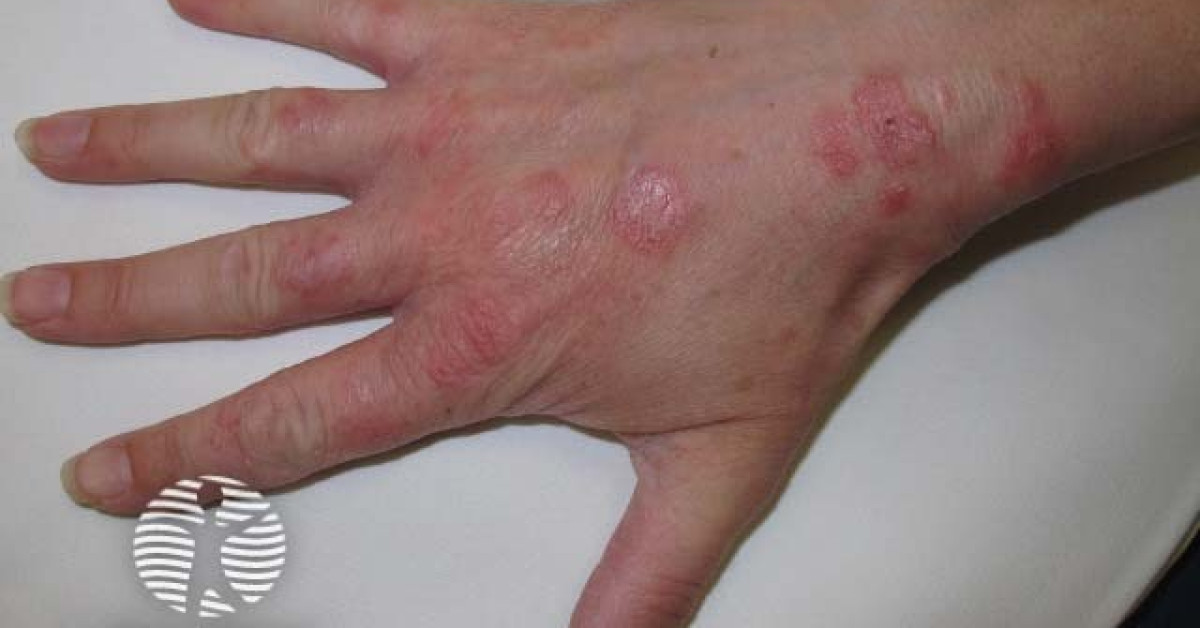 Tinea Pedis Hands
