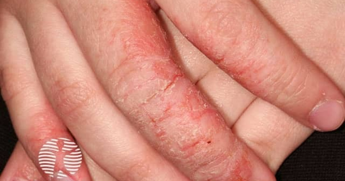 Atopic irritant hand dermatitis image