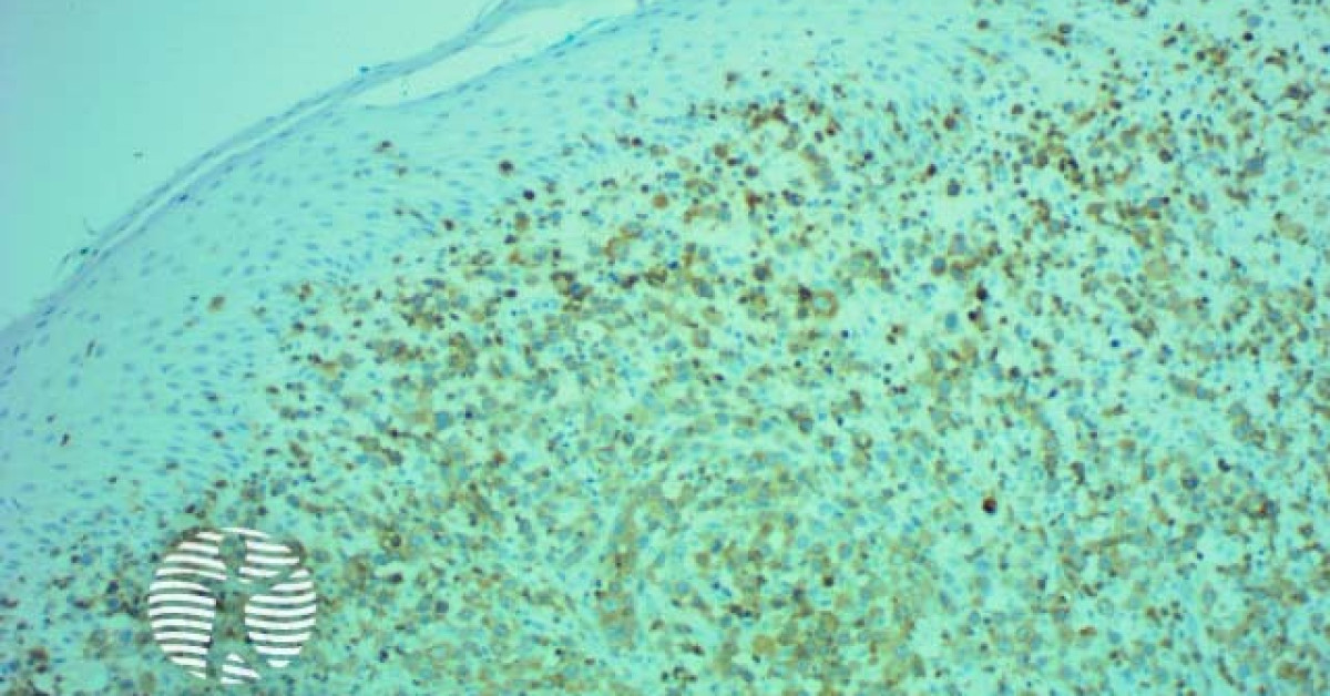 Transformed mycosis fungoides pathology stained with CD3 x100 image