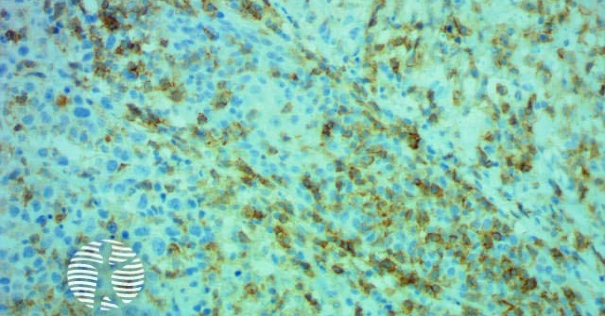 Transformed mycosis fungoides pathology stained with CD4 x200 image
