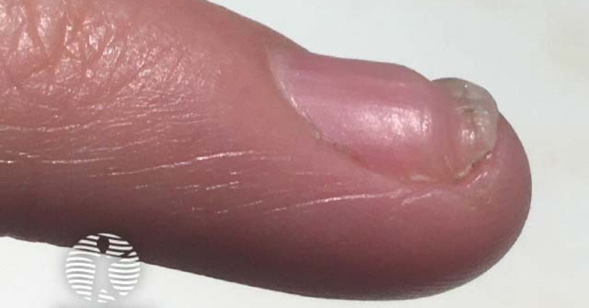 Transverse groove in nail image