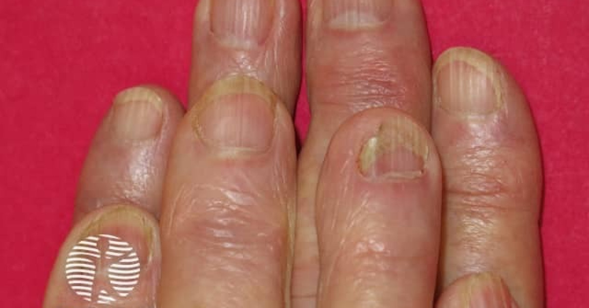 Acitretin nail thinning image