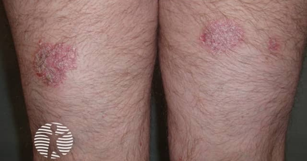 Psoriasis before commencing adalimumab image