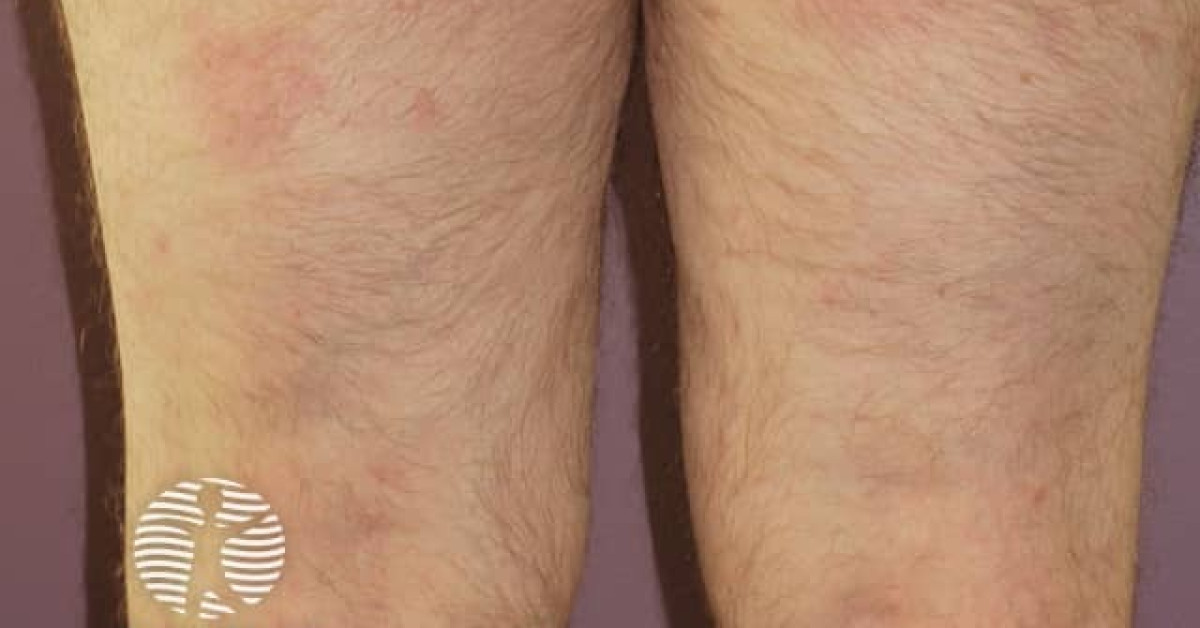 Psoriasis 6 months after commencing adalimumab image