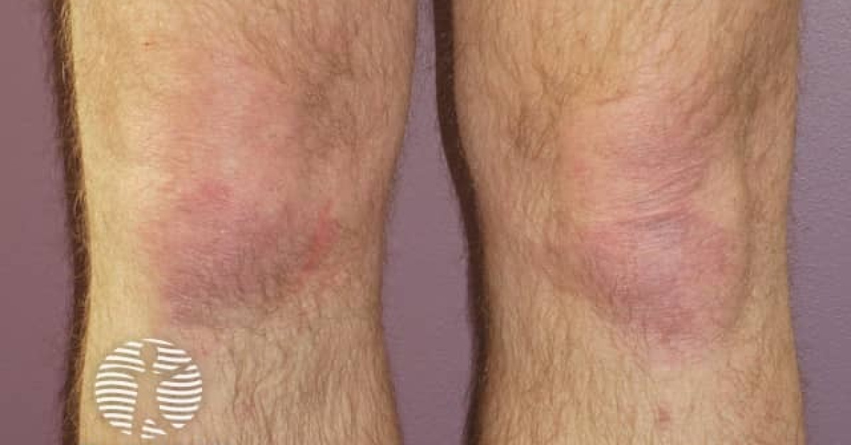 Psoriasis 6 months after commencing adalimumab image