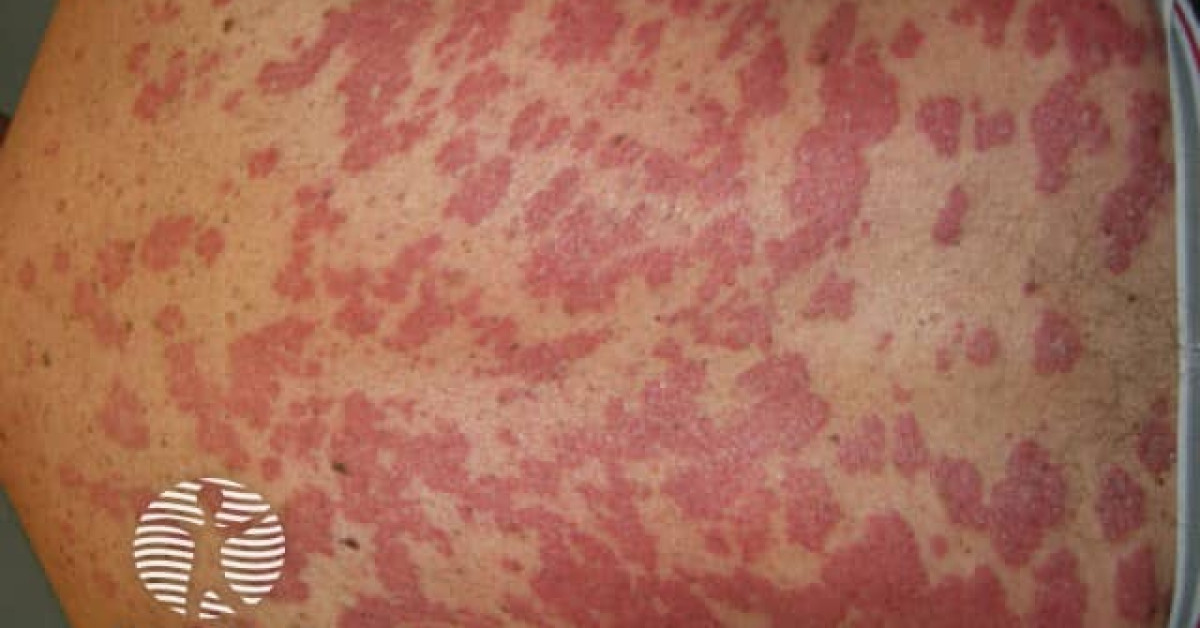 Psoriasis before commencing adalimumab image
