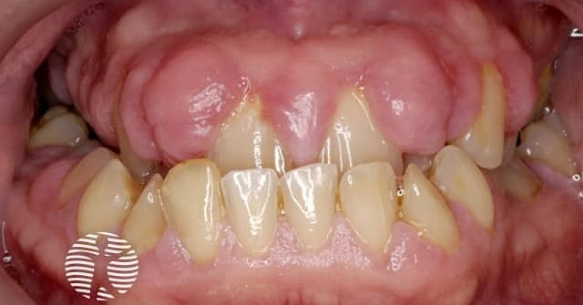 Gum hypertrophy due to ciclosporin image