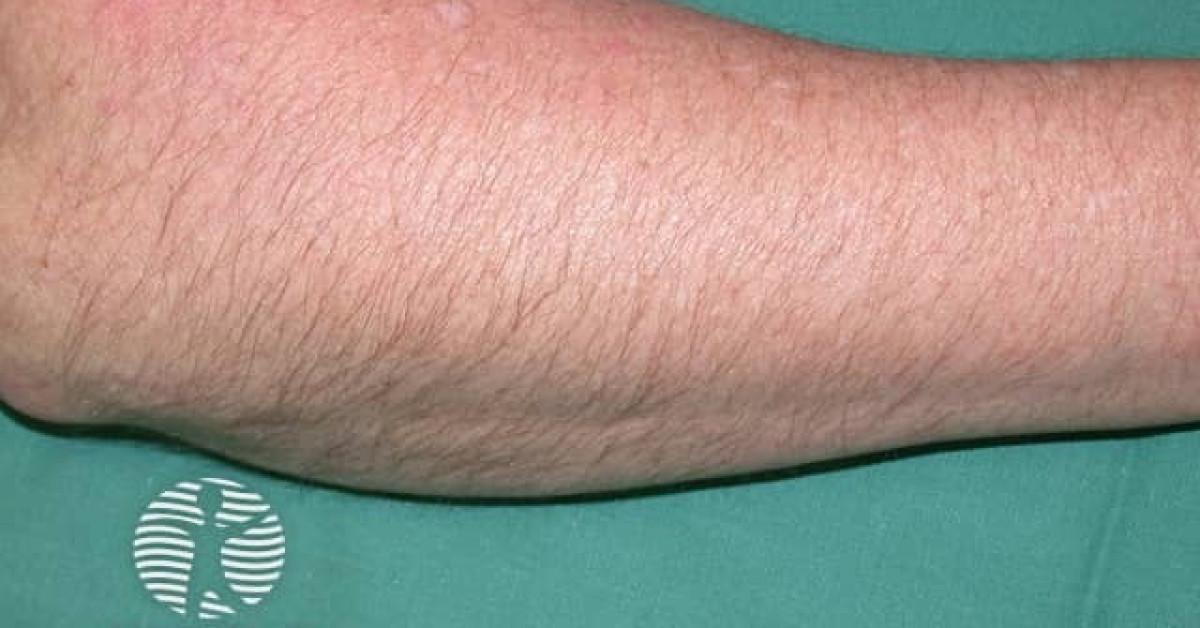 Hypertrichosis due to ciclosporin image