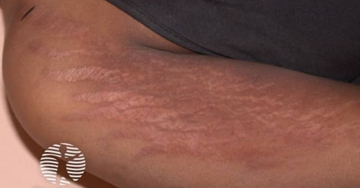 Stretch marks from Dermovate cream image