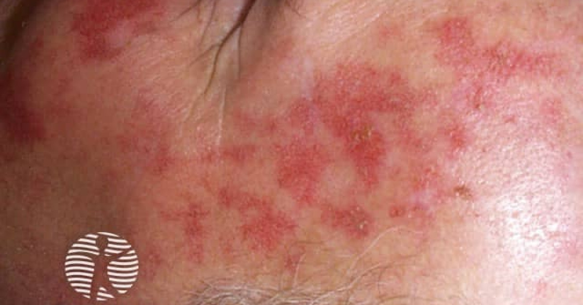 5-fluorouracil cream effect image