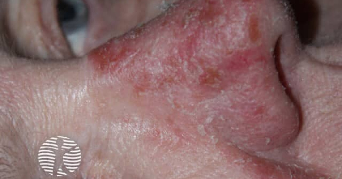 Effects of ingenol mebutate gel on facial actinic keratoses image