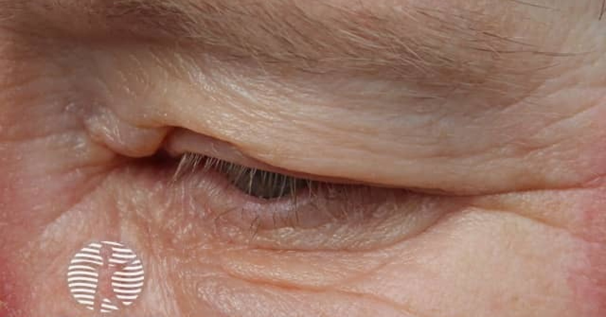 Eyelid swelling from ingenol mebutate gel image