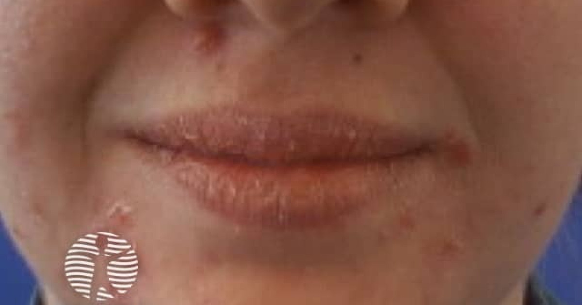 DermNet® - isot cheilitis2 s image