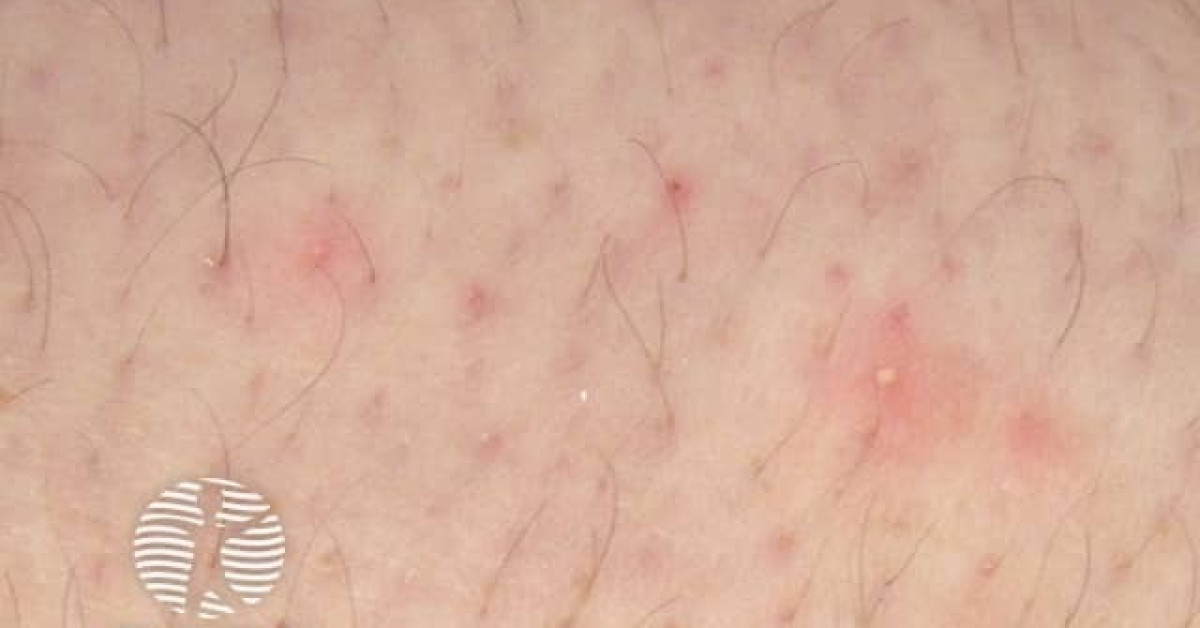 Folliculitis induced by sirolimus image