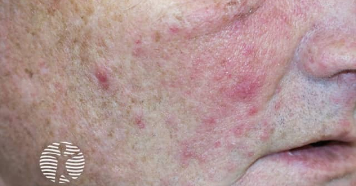 Folliculitis induced by sirolimus image