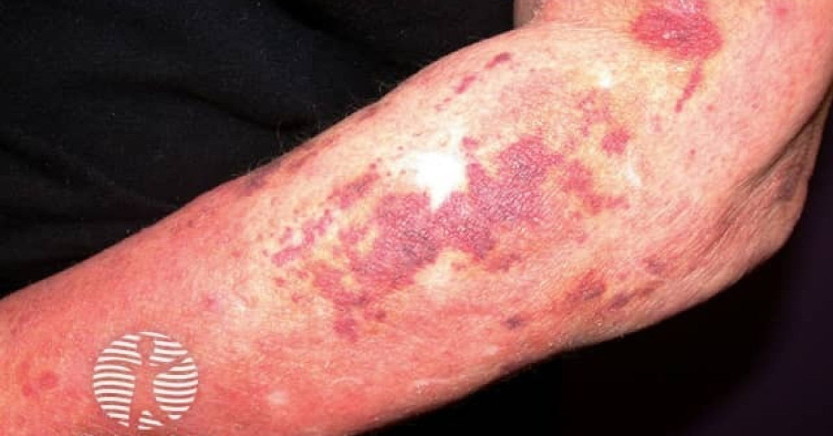 Bruising due to topical steroids image