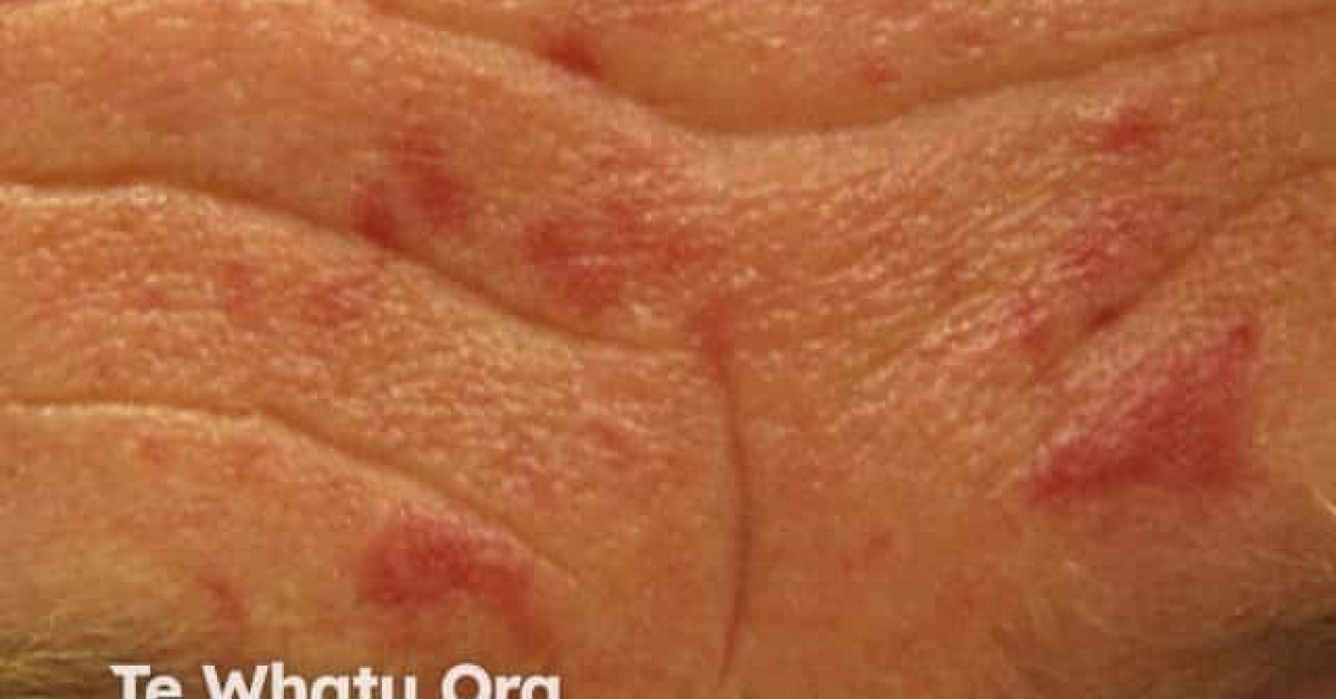 5-fluorouracil cream effect image