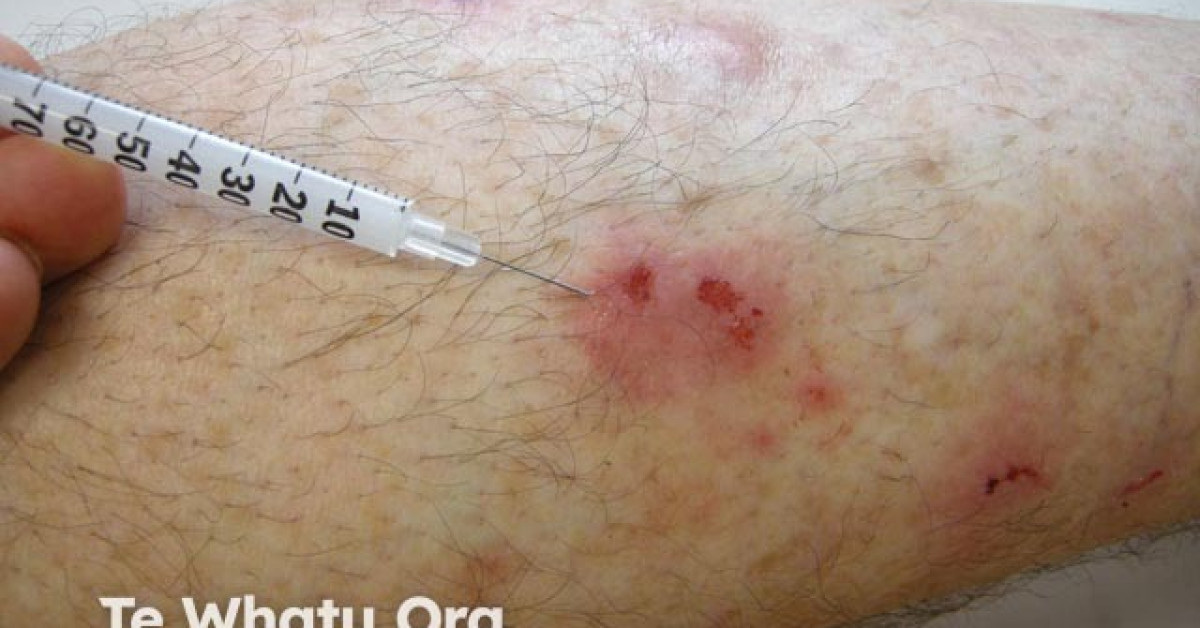 Intralesional steroid injection image