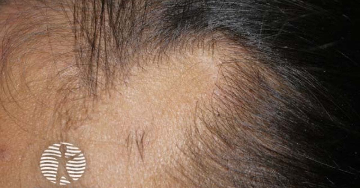 Triangular temporal alopecia image