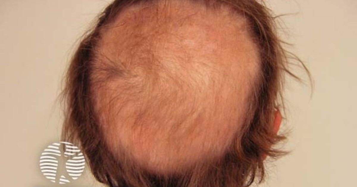 Trichotillomania image