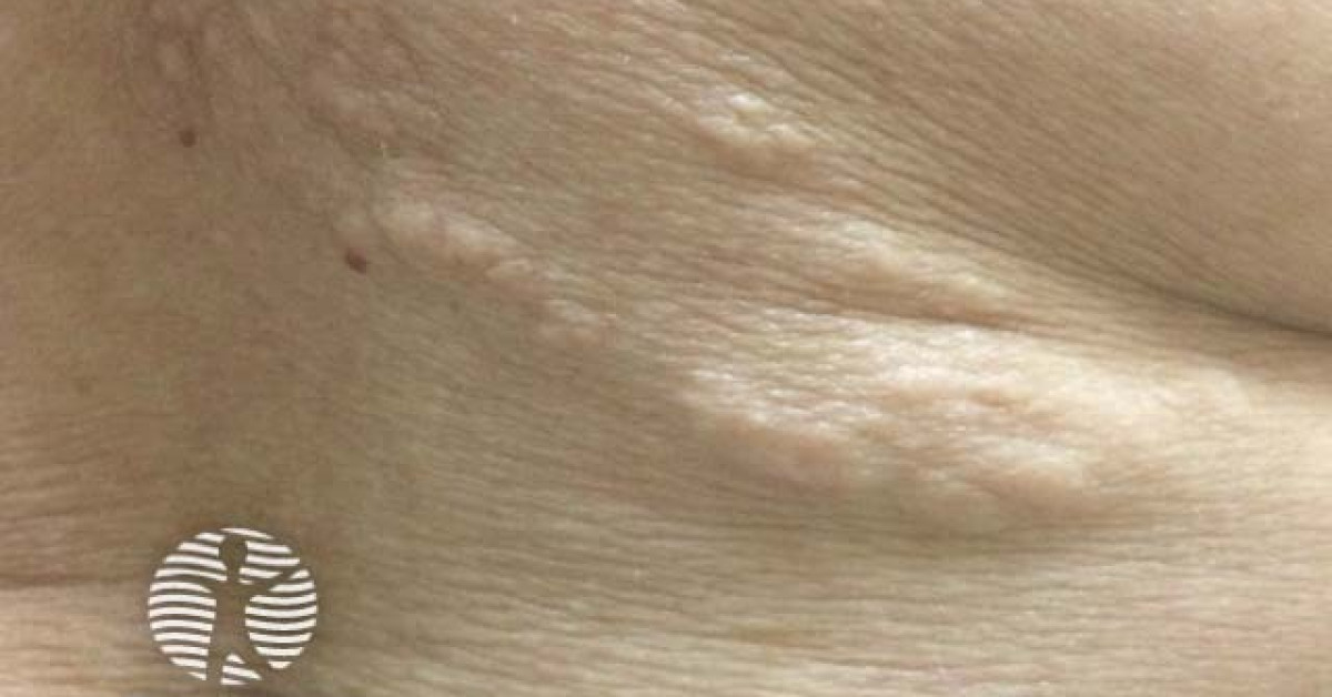 Tuberous sclerosis shagreen patch image