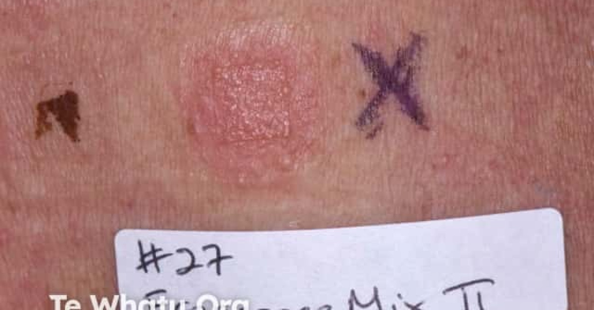 Positive patch test to fragrance image