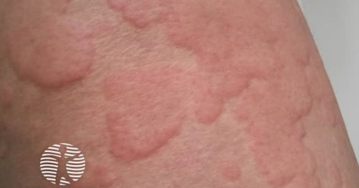 Acute Urticaria Image acute-urticaria-image